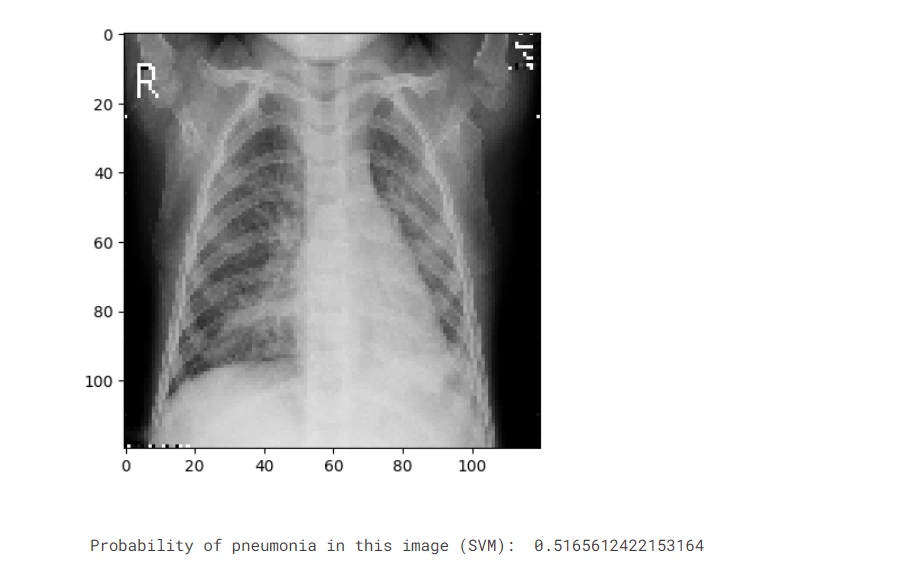 ML Beginner's Guide To Build Pneumonia Detection Model
